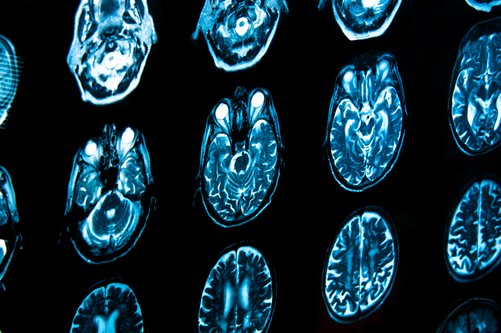 Remembering Henry Molaison | Brain Blogger