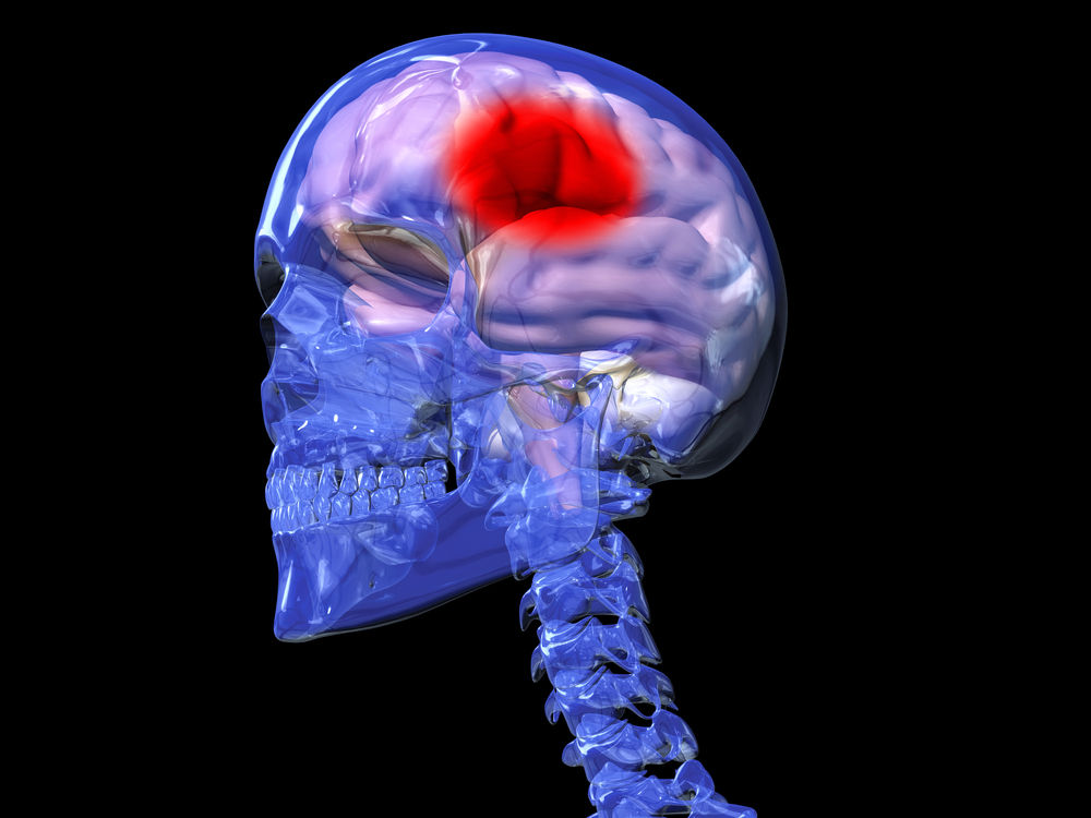 Technology for Acute Strokes – Interview with BrainAttack App Developer ...